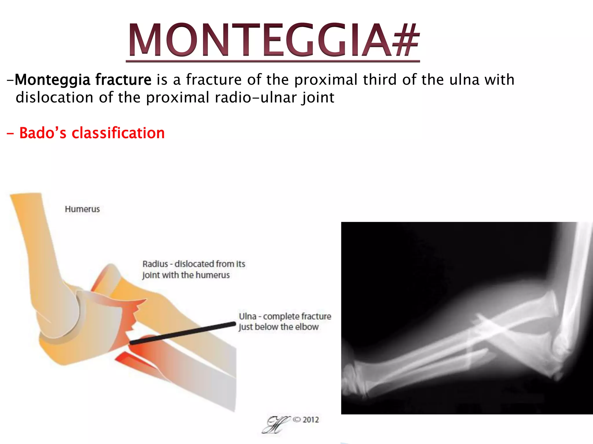 Fractures and dislocations- Upper Limb | PDF