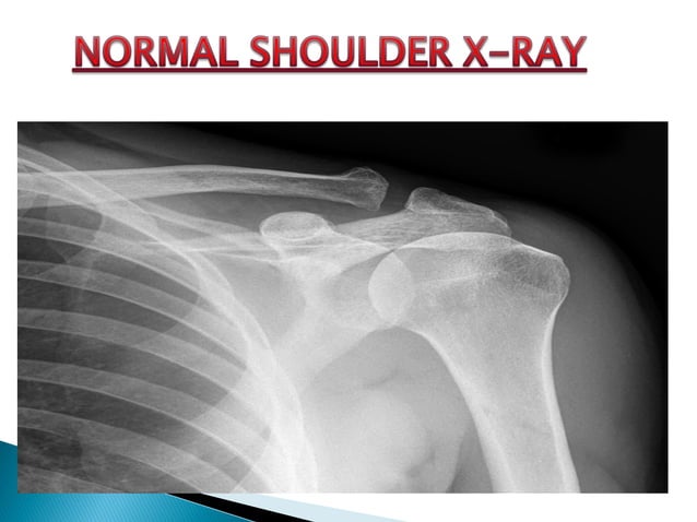 Fractures and dislocations- Upper Limb | PPT