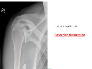 Fractures and dislocations- Upper Limb | PDF