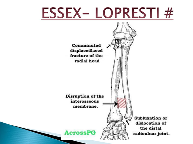 Fractures and dislocations- Upper Limb | PPT