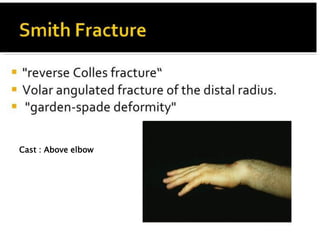 Fractures and dislocations- Upper Limb | PDF