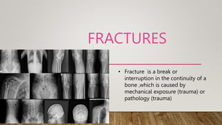 Fractures and Dislocations. Of joints pptx | PPTX