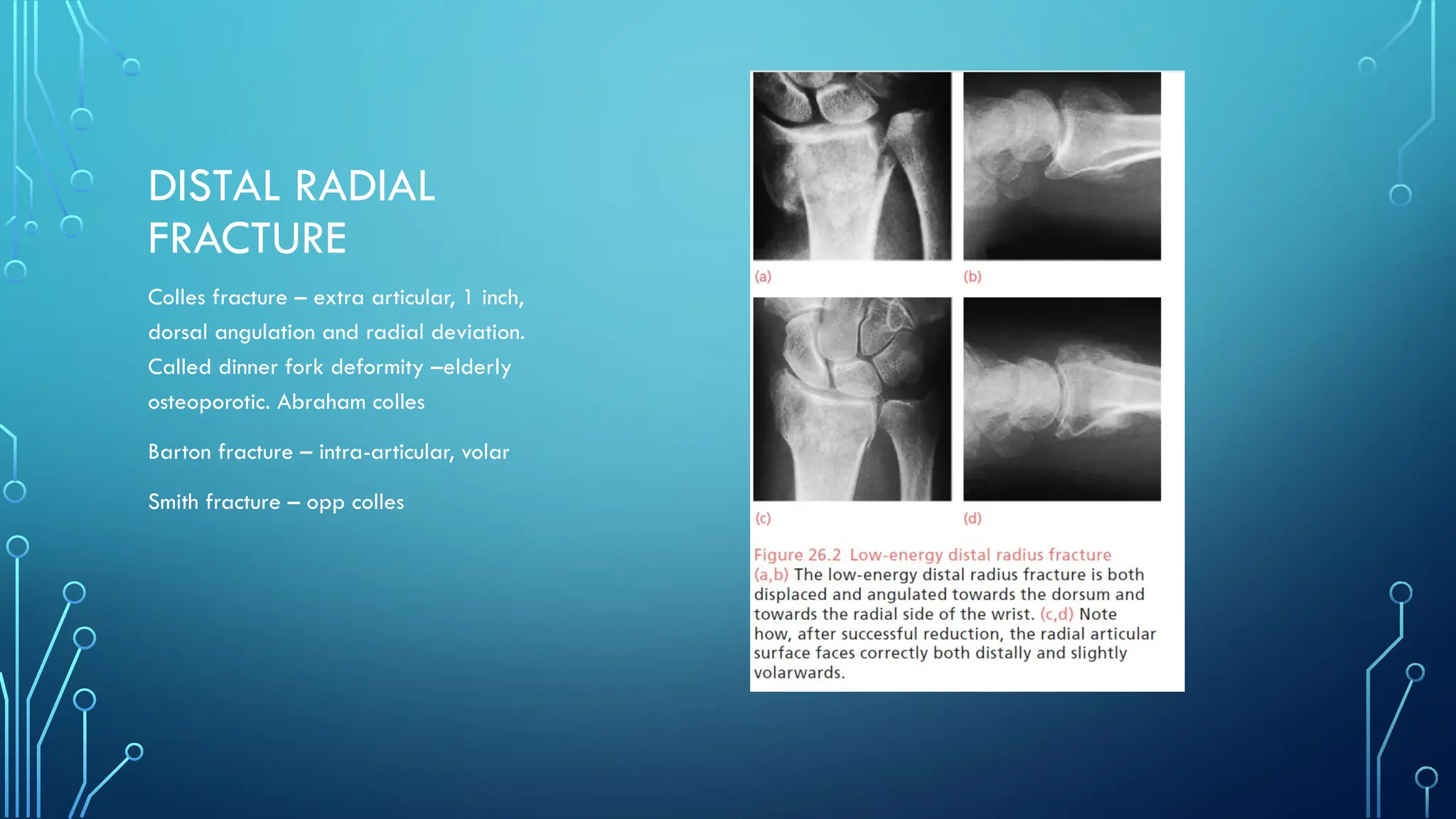 FRACTURES AND dislocation of upperl.pptx