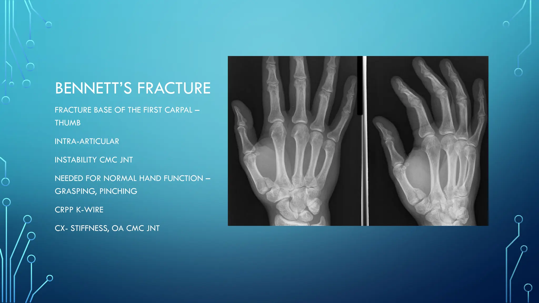 FRACTURES AND dislocation of upperl.pptx