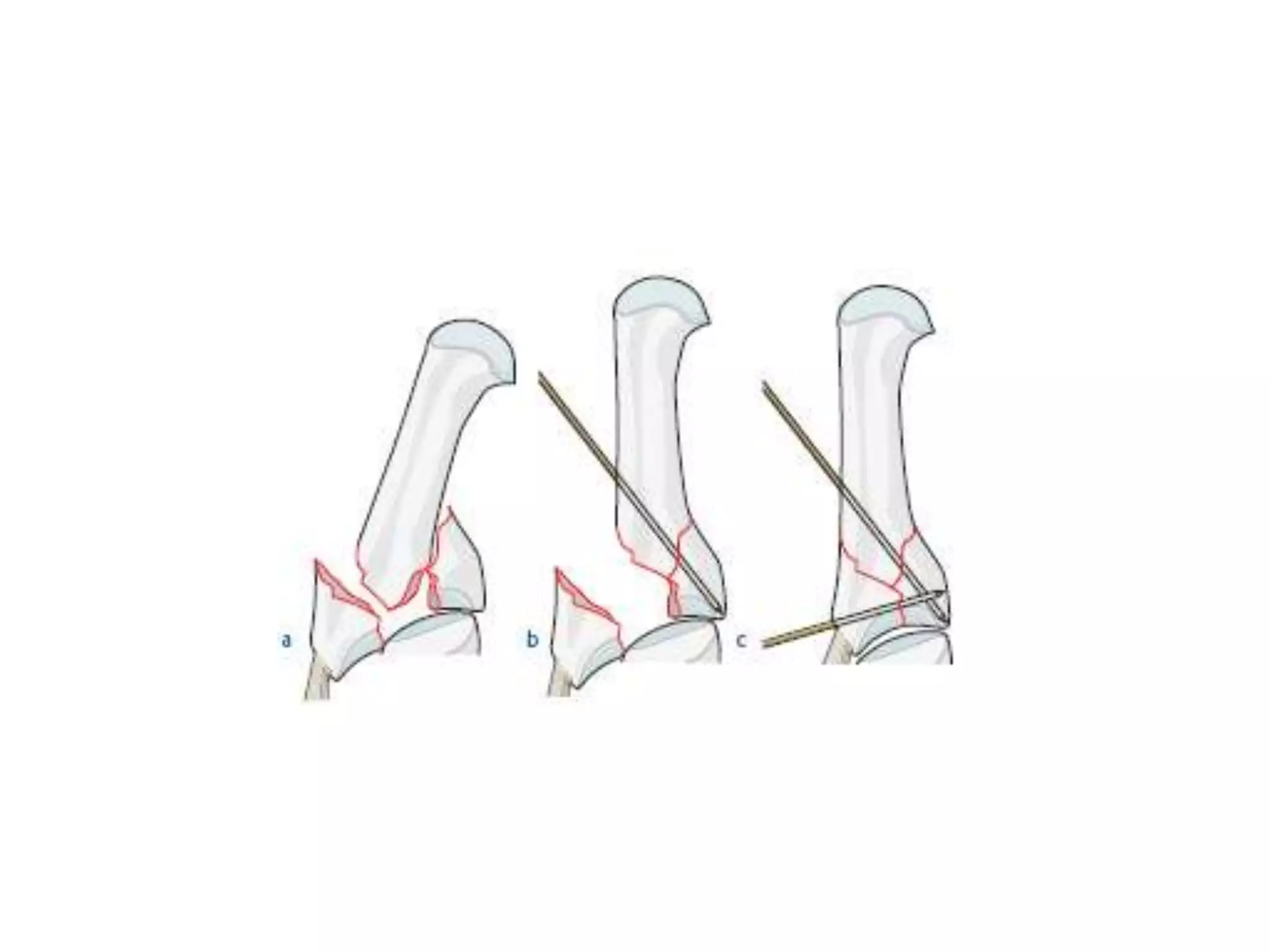 Fractures and dislocations of hand | PPTX