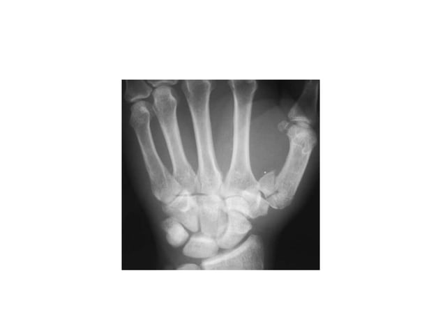 Fractures and dislocations of hand | PPTX | First Aid | Injuries