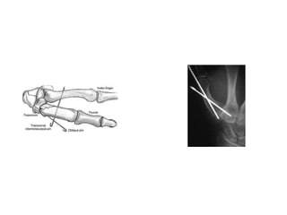 Fractures and dislocations of hand | PPTX