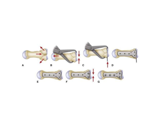 Fractures and dislocations of hand | PPTX | First Aid | Injuries