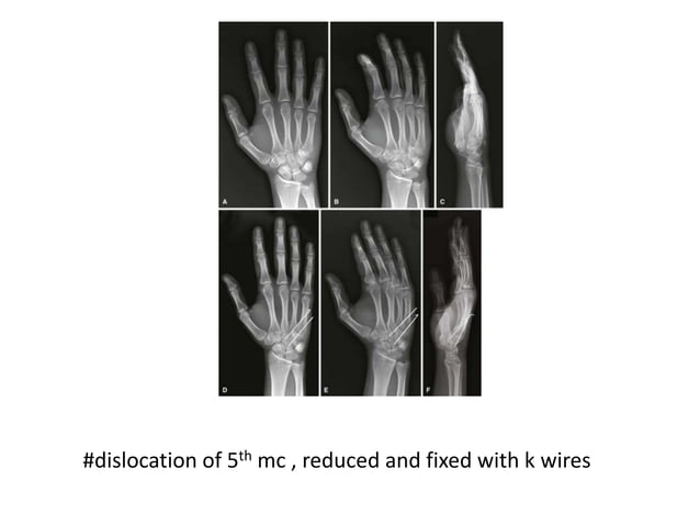 Fractures and dislocations of hand | PPTX | First Aid | Injuries