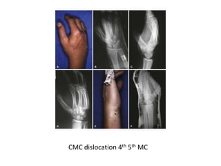 Fractures and dislocations of hand | PPTX