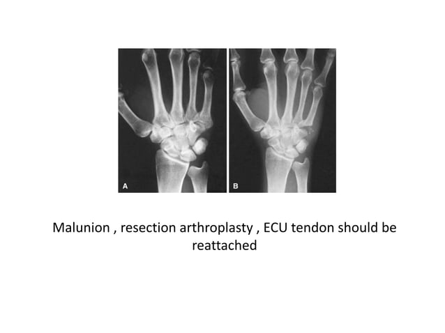 Fractures and dislocations of hand | PPTX | First Aid | Injuries