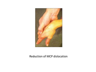 Fractures and dislocations of hand | PPTX