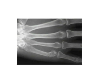 Fractures and dislocations of hand | PPTX