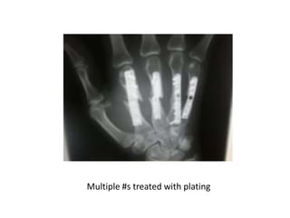 Fractures and dislocations of hand | PPTX