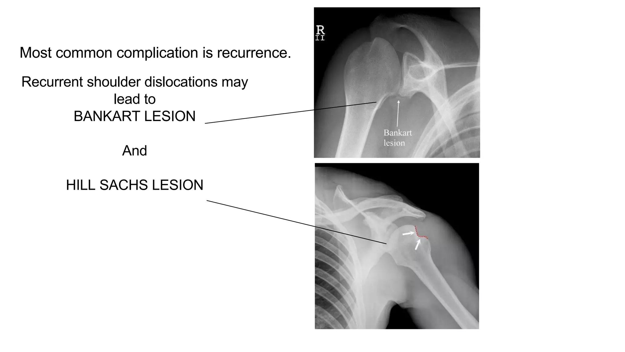 Fractures and dislocation upper limb .pptx