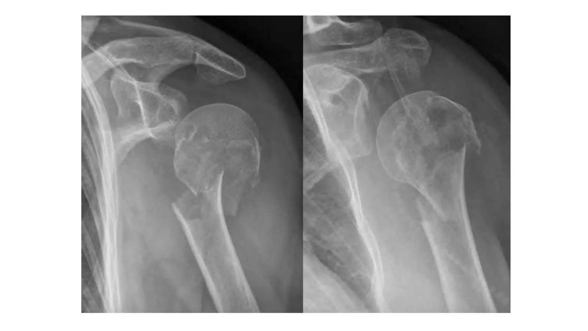 Fractures and dislocation upper limb .pptx