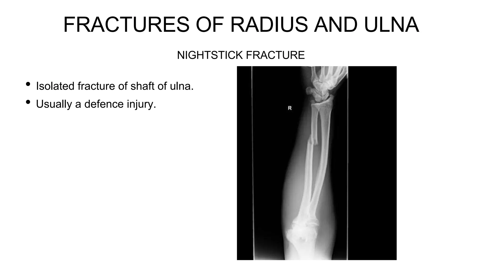 Fractures and dislocation upper limb .pptx
