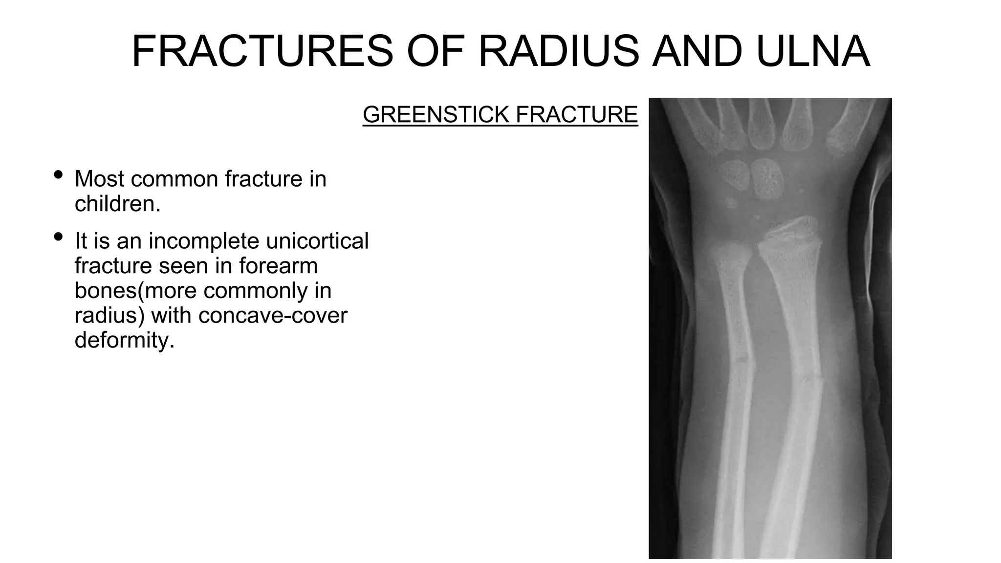 Fractures and dislocation upper limb .pptx