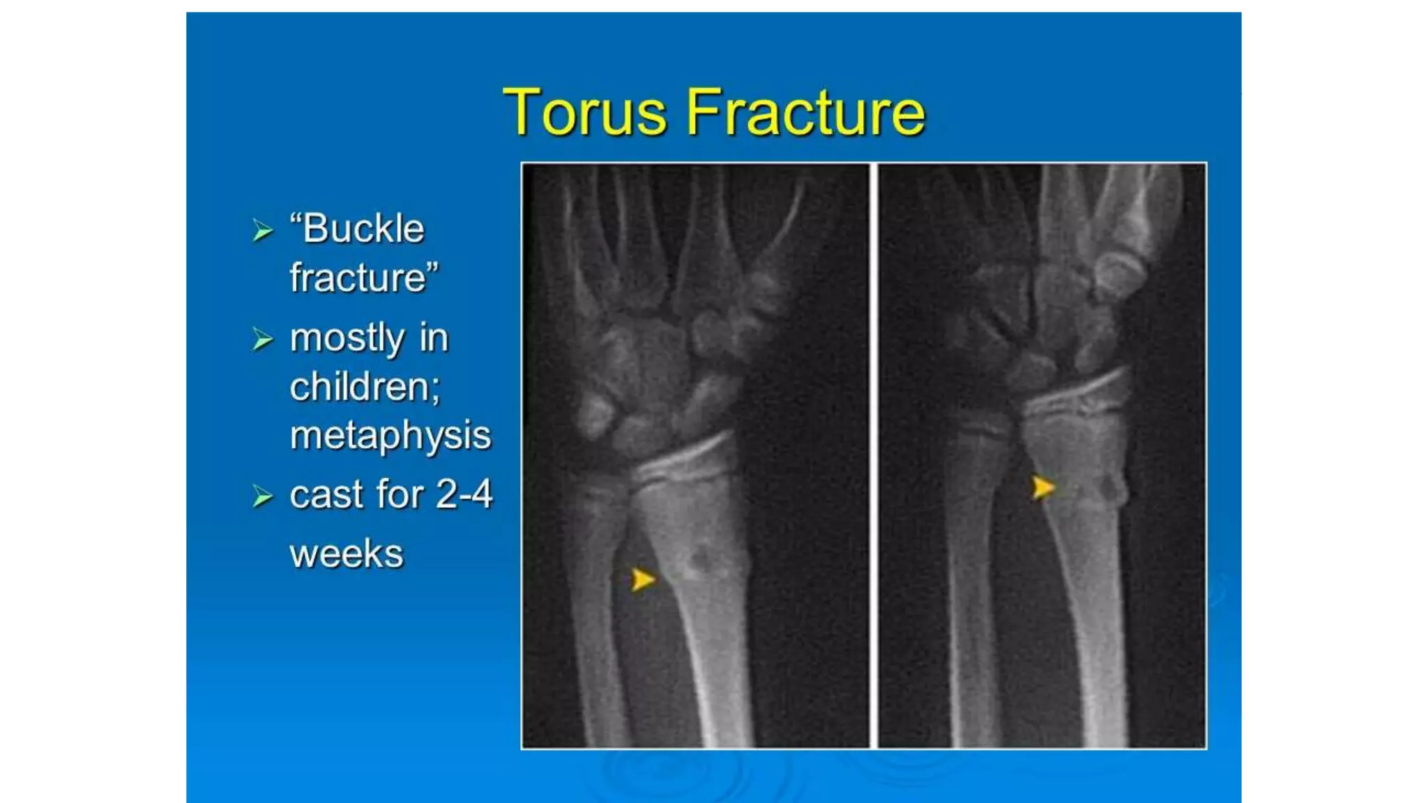 Fractures and dislocation upper limb .pptx