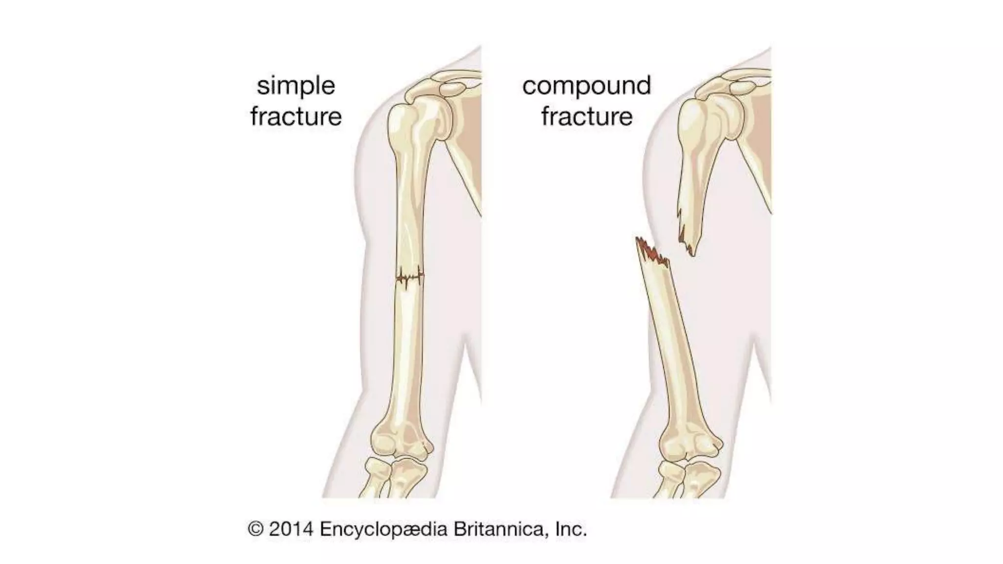 Fractures and dislocation upper limb .pptx