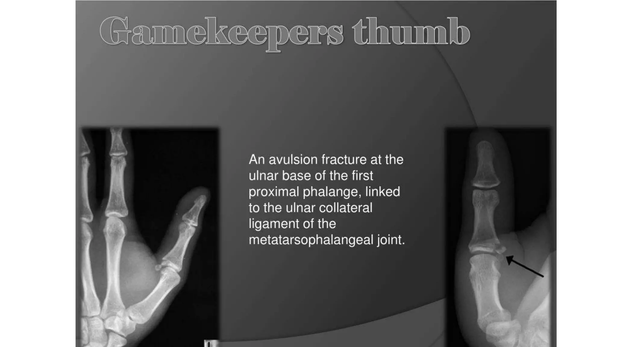 Fractures and dislocation upper limb .pptx