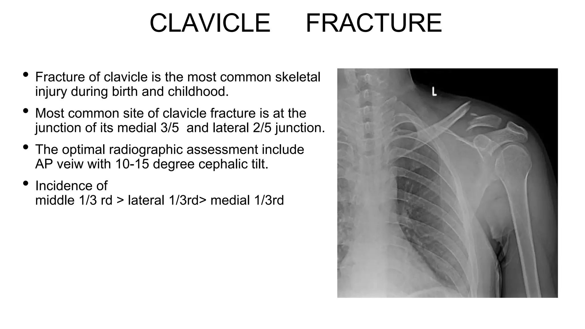 Fractures and dislocation upper limb .pptx