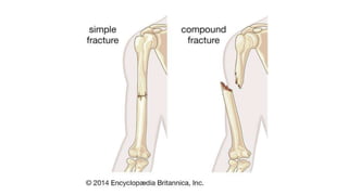 Fractures and dislocation upper limb .pptx