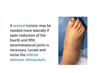 Fractures and fracture dislocations of the tarsometatarsal joint | PPTX