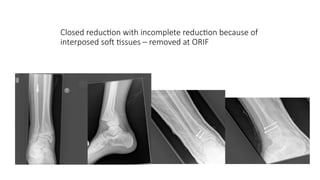 PAEDIATRIC ANKLE FRACTURES OVERVIEW.pptx