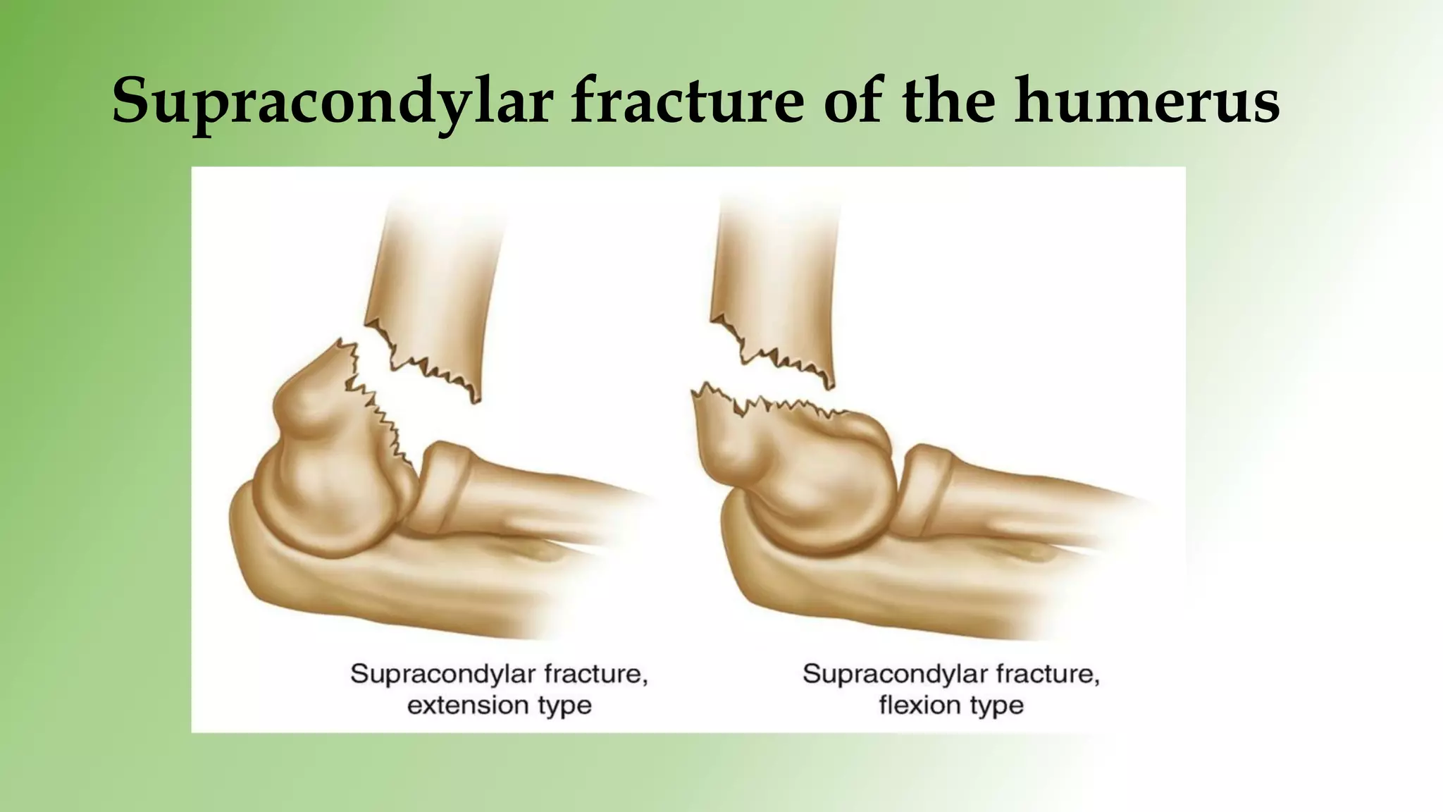fractures around Elbow.pdf