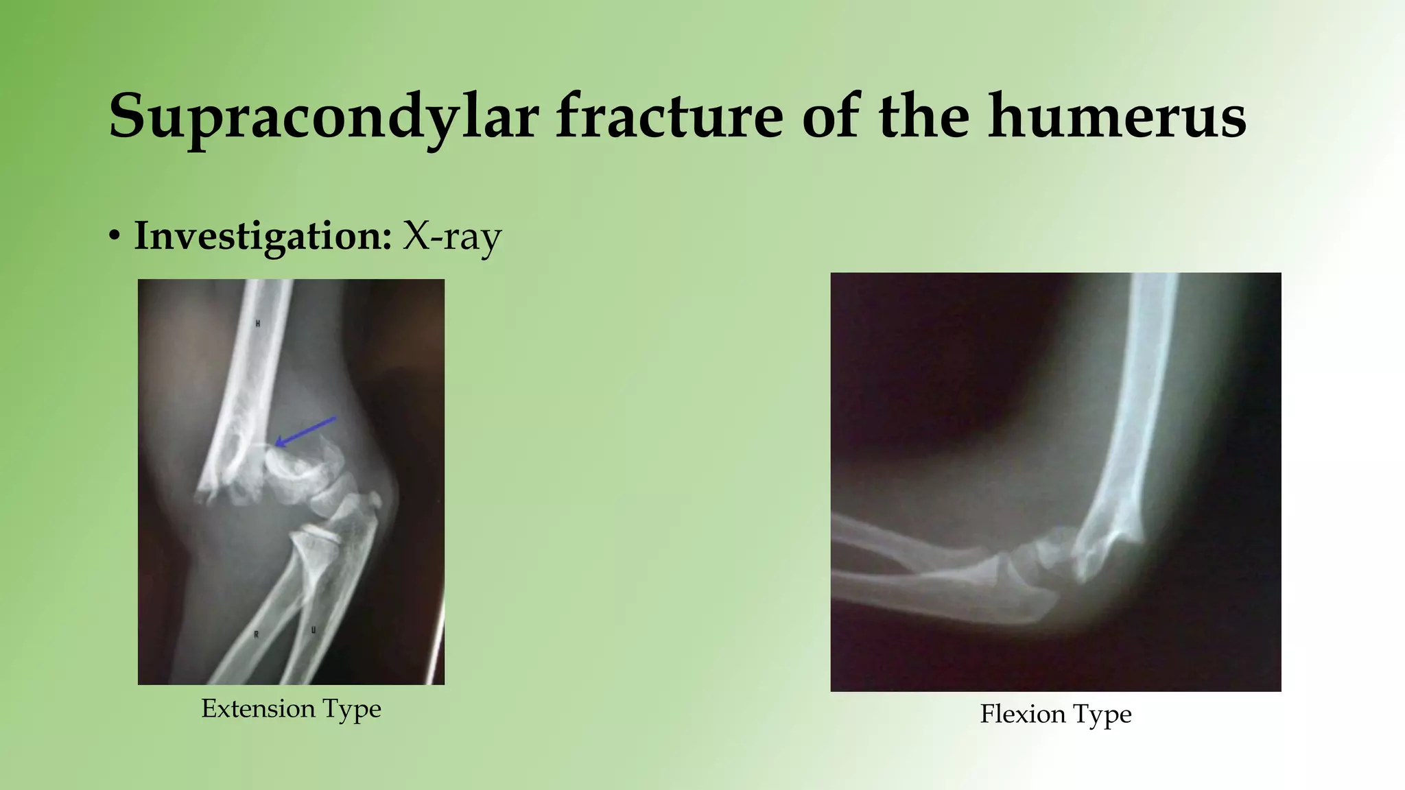 fractures around Elbow.pdf