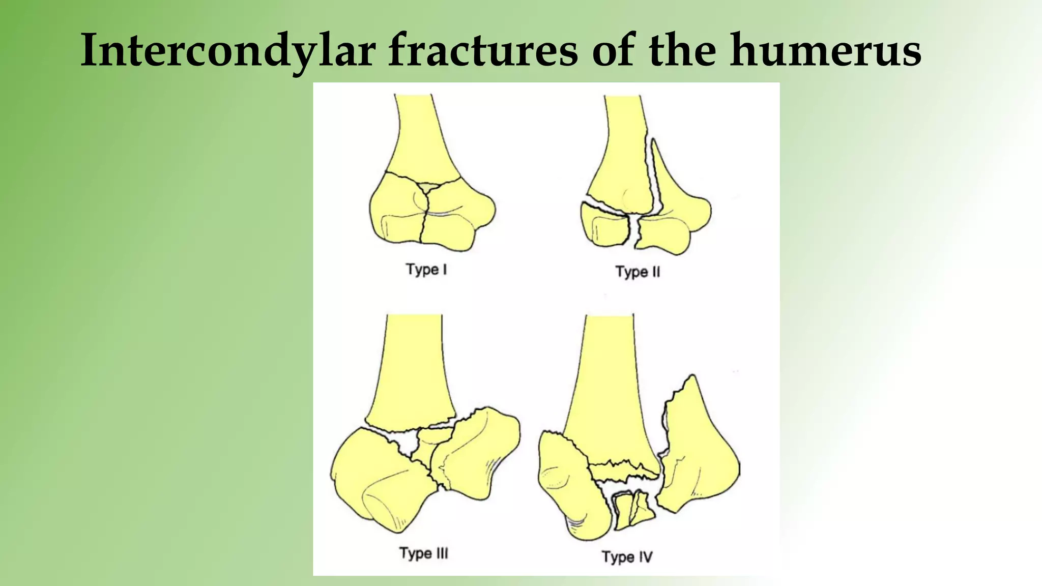 fractures around Elbow.pdf
