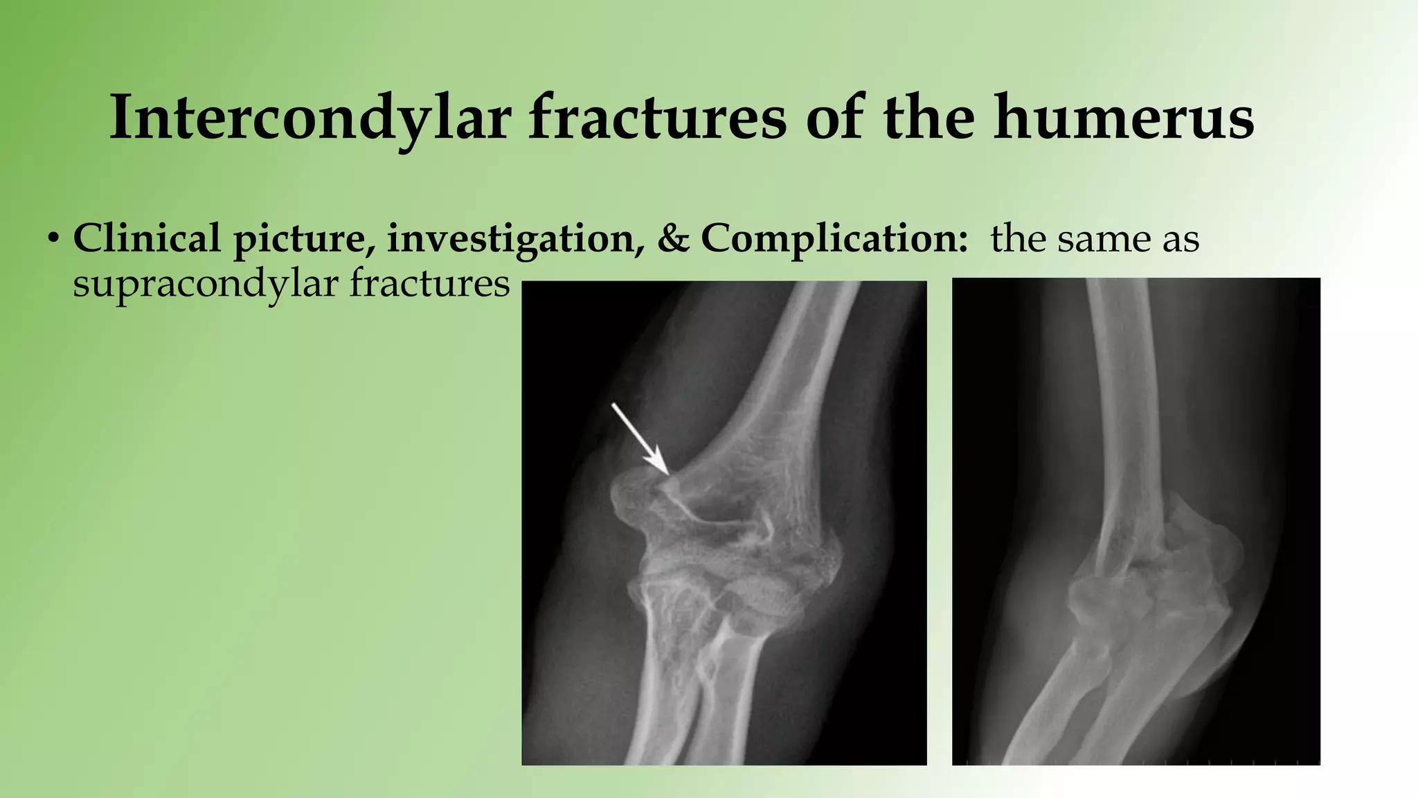 fractures around Elbow.pdf