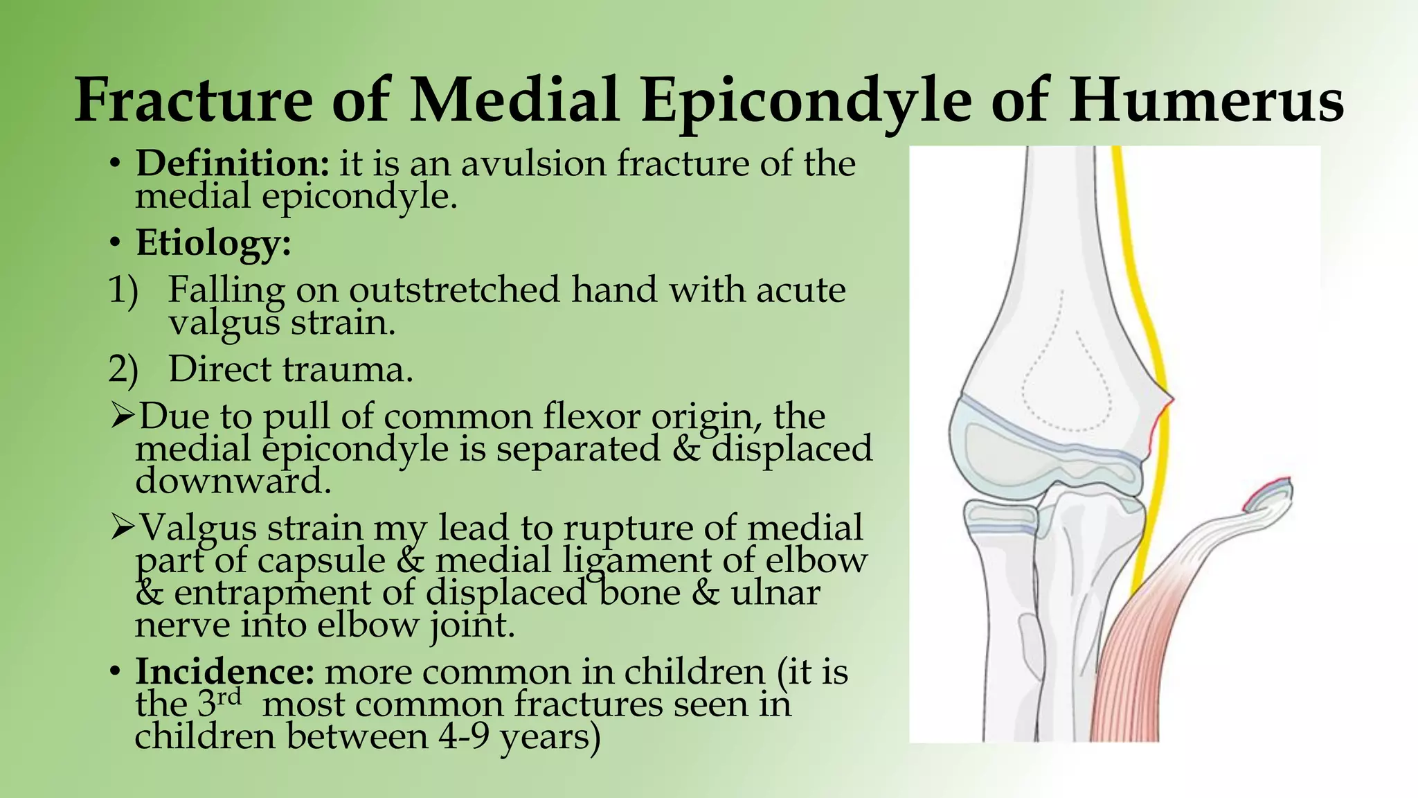 fractures around Elbow.pdf