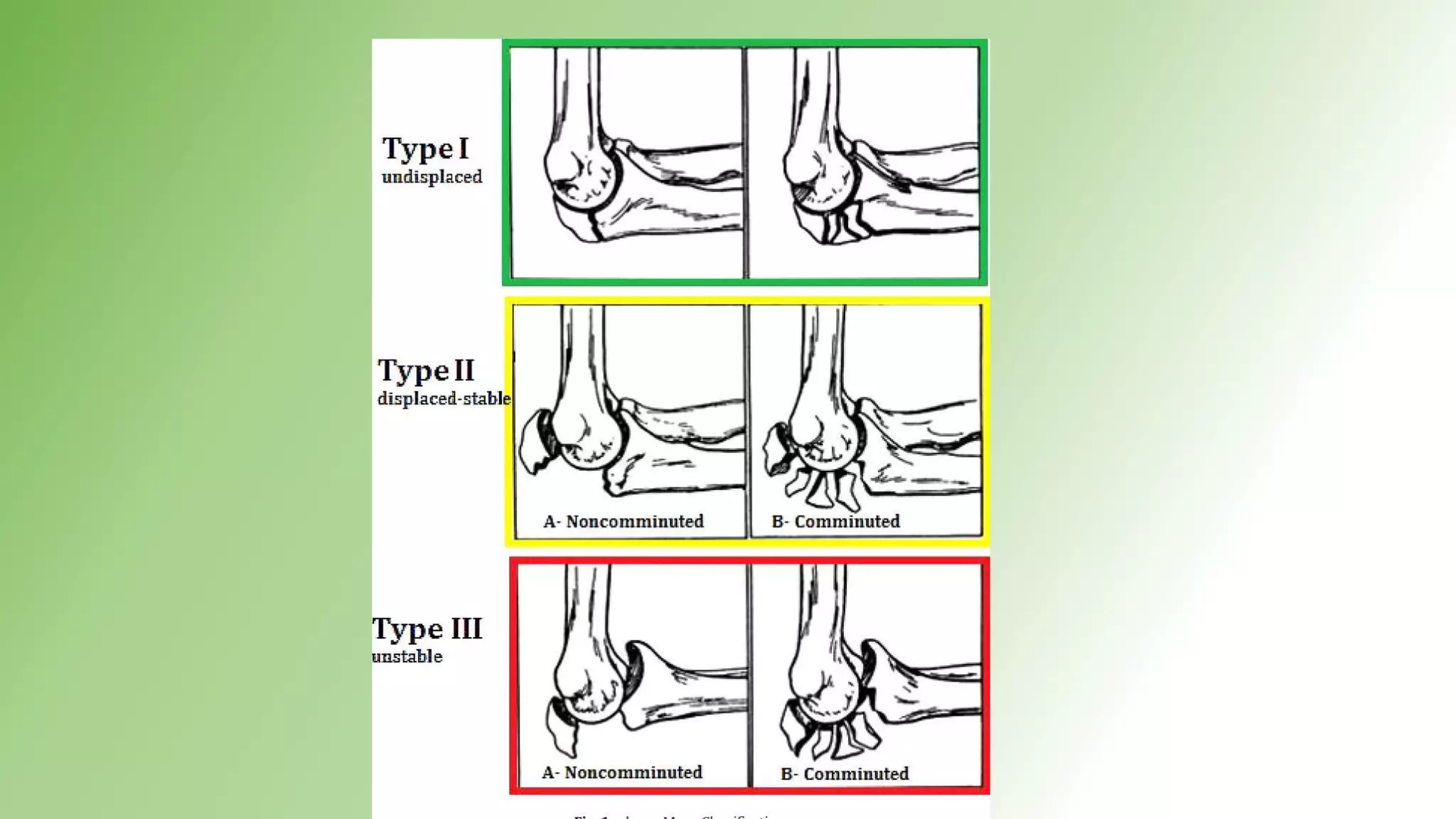 fractures around Elbow.pdf