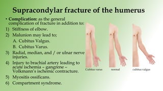 fractures around Elbow.pdf