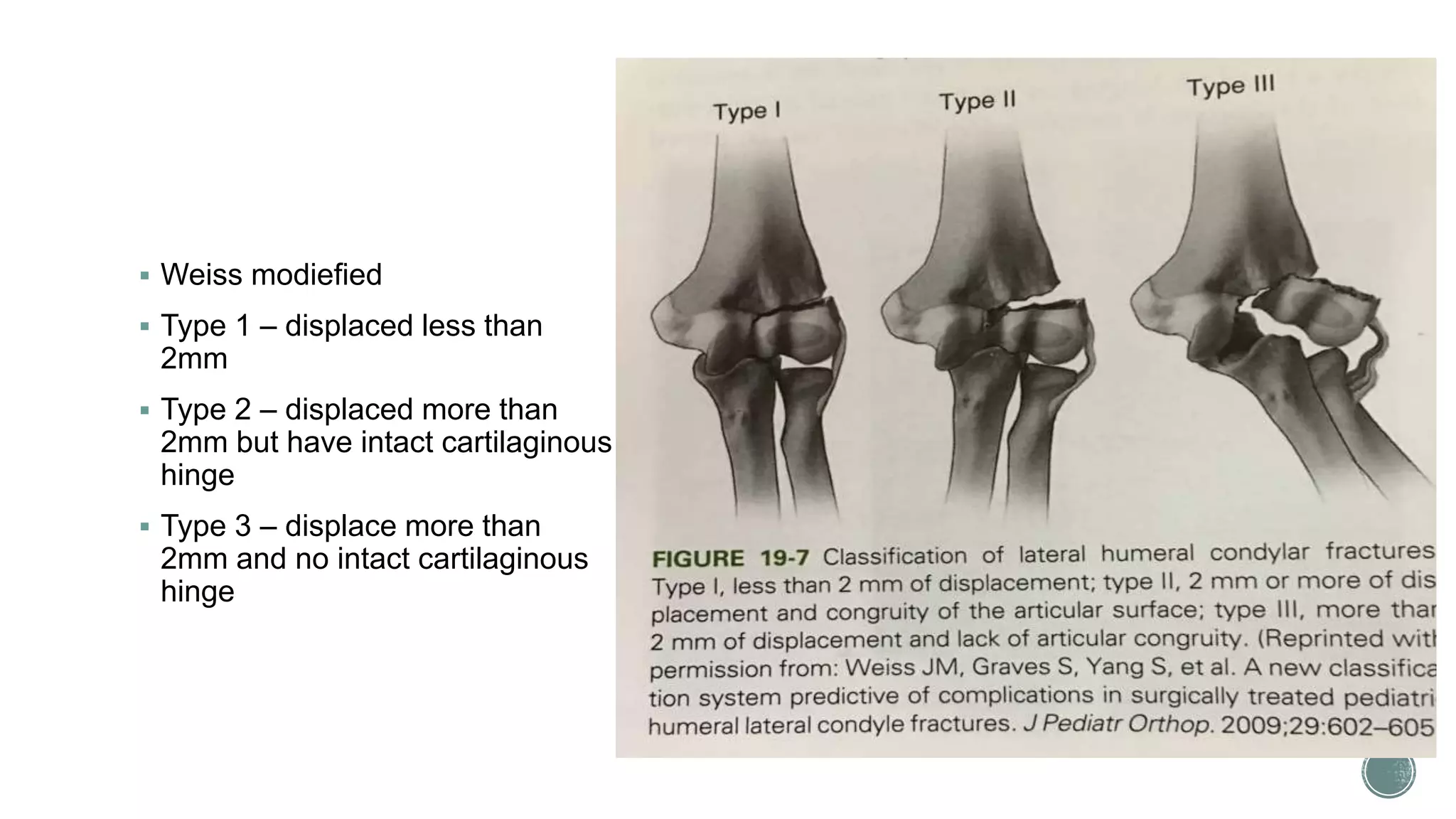 Fractures around elbow joint in children | PPTX