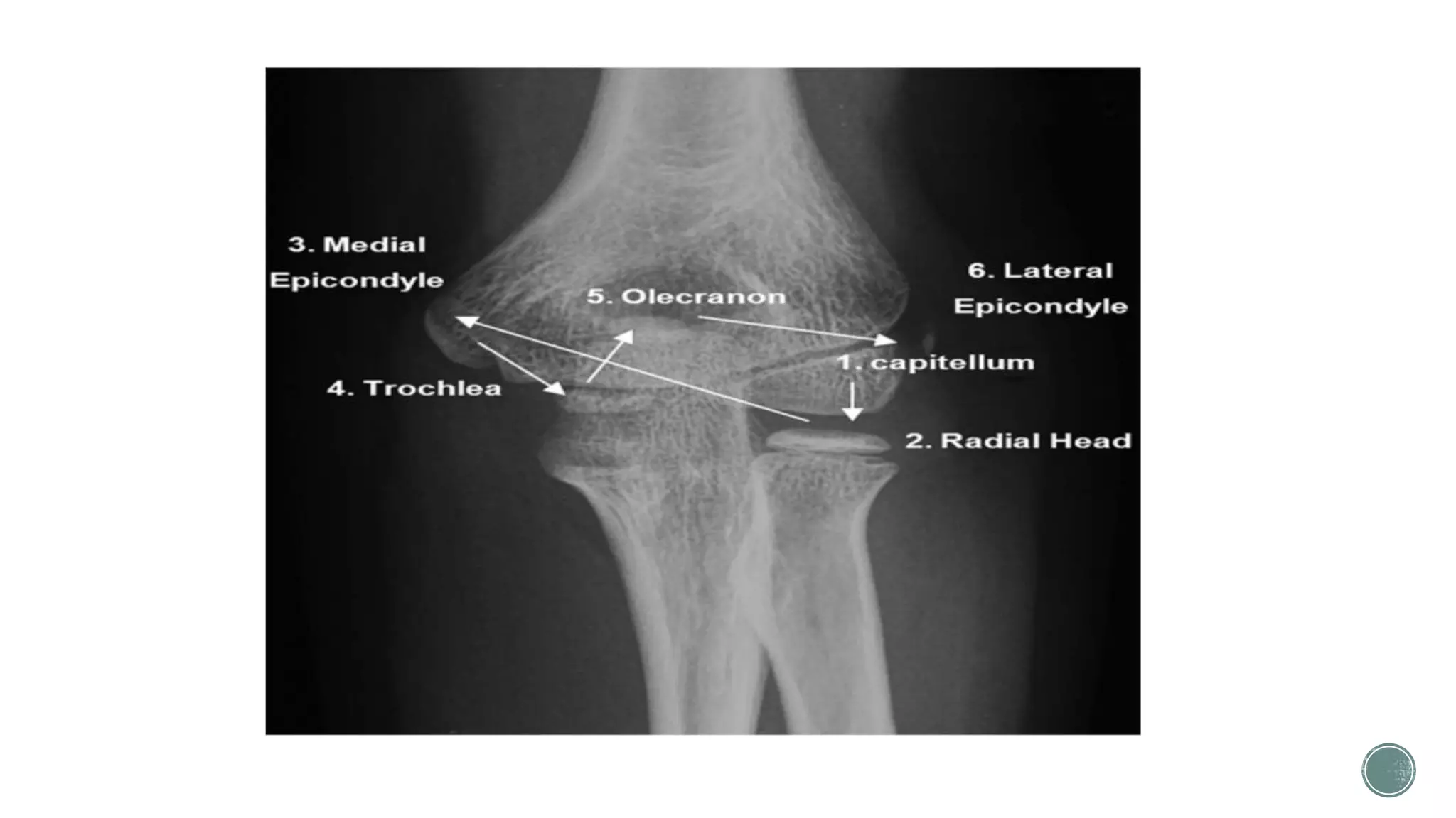 Fractures around elbow joint in children | PPTX