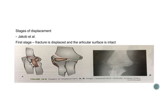 Fractures around elbow joint in children | PPTX