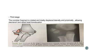 Fractures around elbow joint in children | PPTX