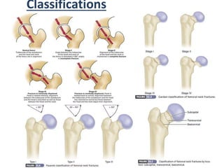 Fractures around hip | PPTX