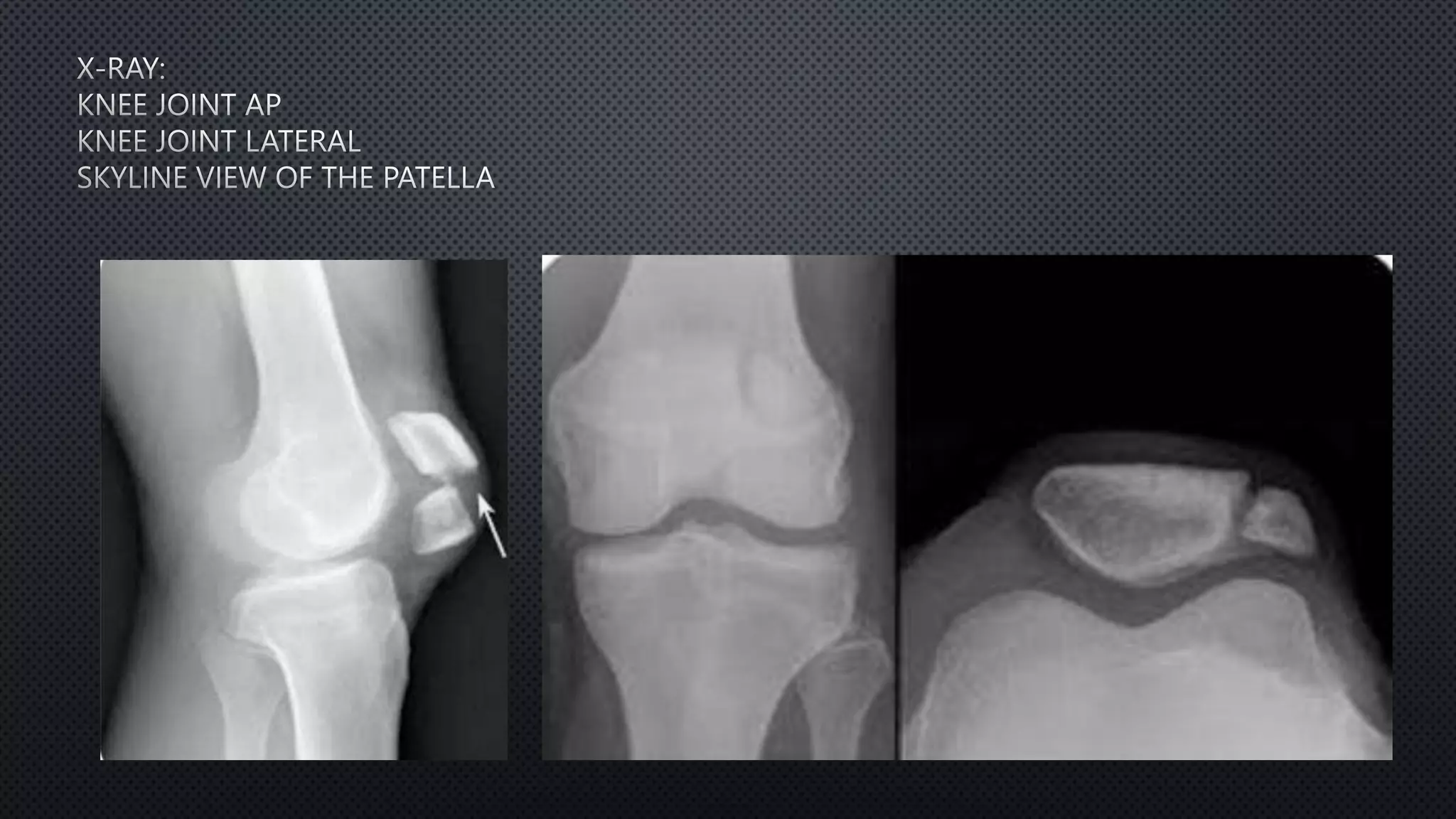 fractures around knee.pptx