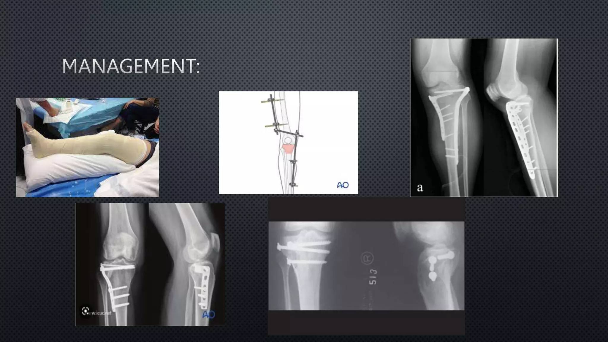 fractures around knee.pptx | Death, Injury, or Military Conflict | Sensitive Topics