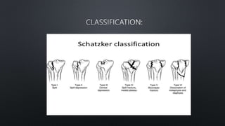 fractures around knee.pptx