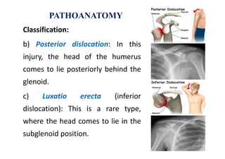 Fractures around shoulder | PDF