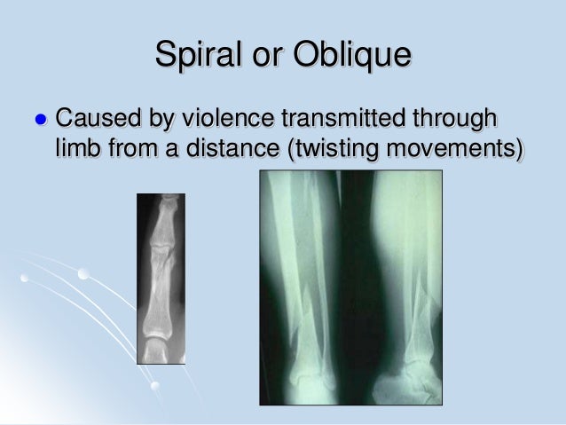 Description of spiral fracture - ideaden