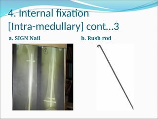 FRACTURES, definition, classification, management 4.2 BMS.pptx