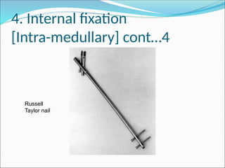 FRACTURES, definition, classification, management 4.2 BMS.pptx