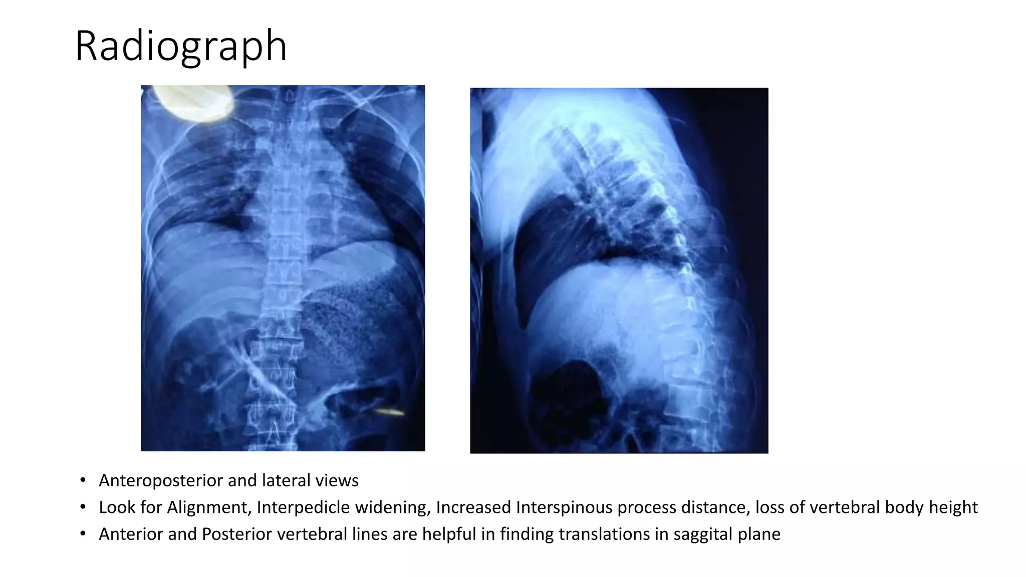 fractures & dislocation spine.pptx