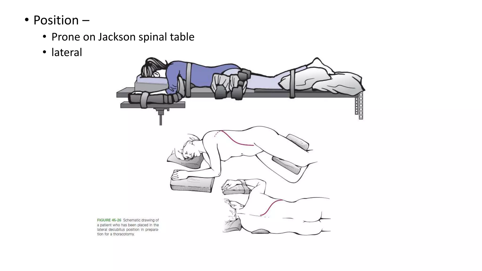 fractures & dislocation spine.pptx